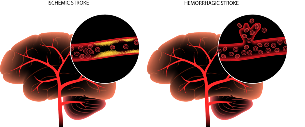 Carotid Artery Blockage And Stroke - Expert IR- Neuro And Vascular Clinic