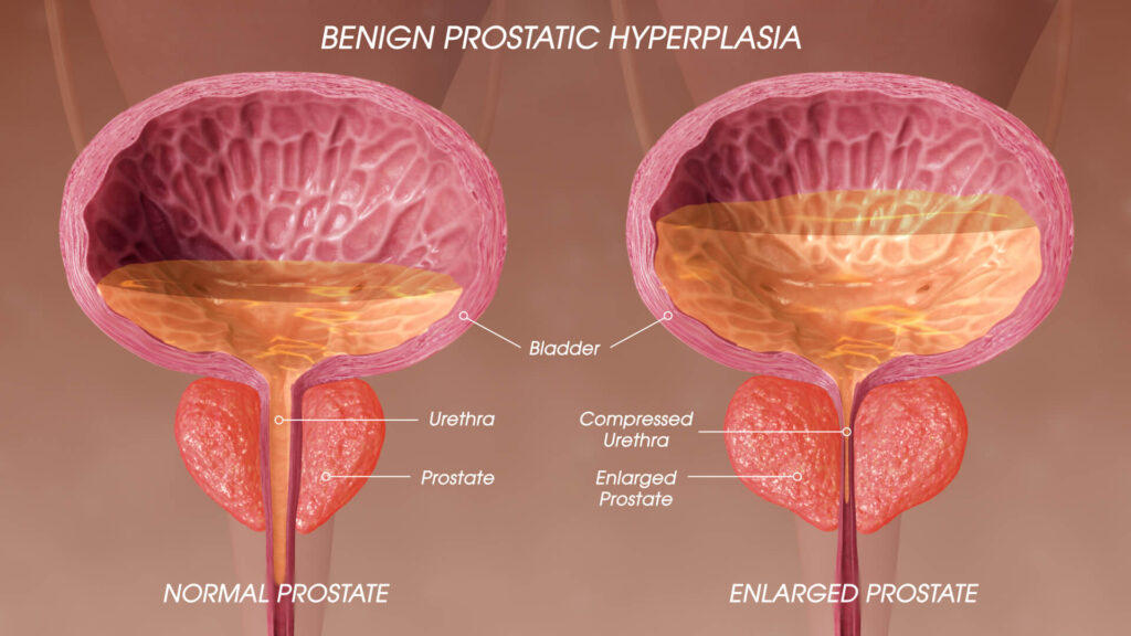 Prostate Enlargement - Expert IR- Neuro And Vascular Clinic